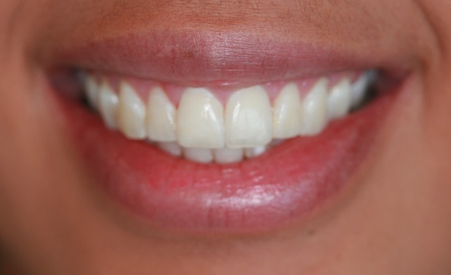 A New Technique to Treat 'Gummy Smile and Discolored Gums ...